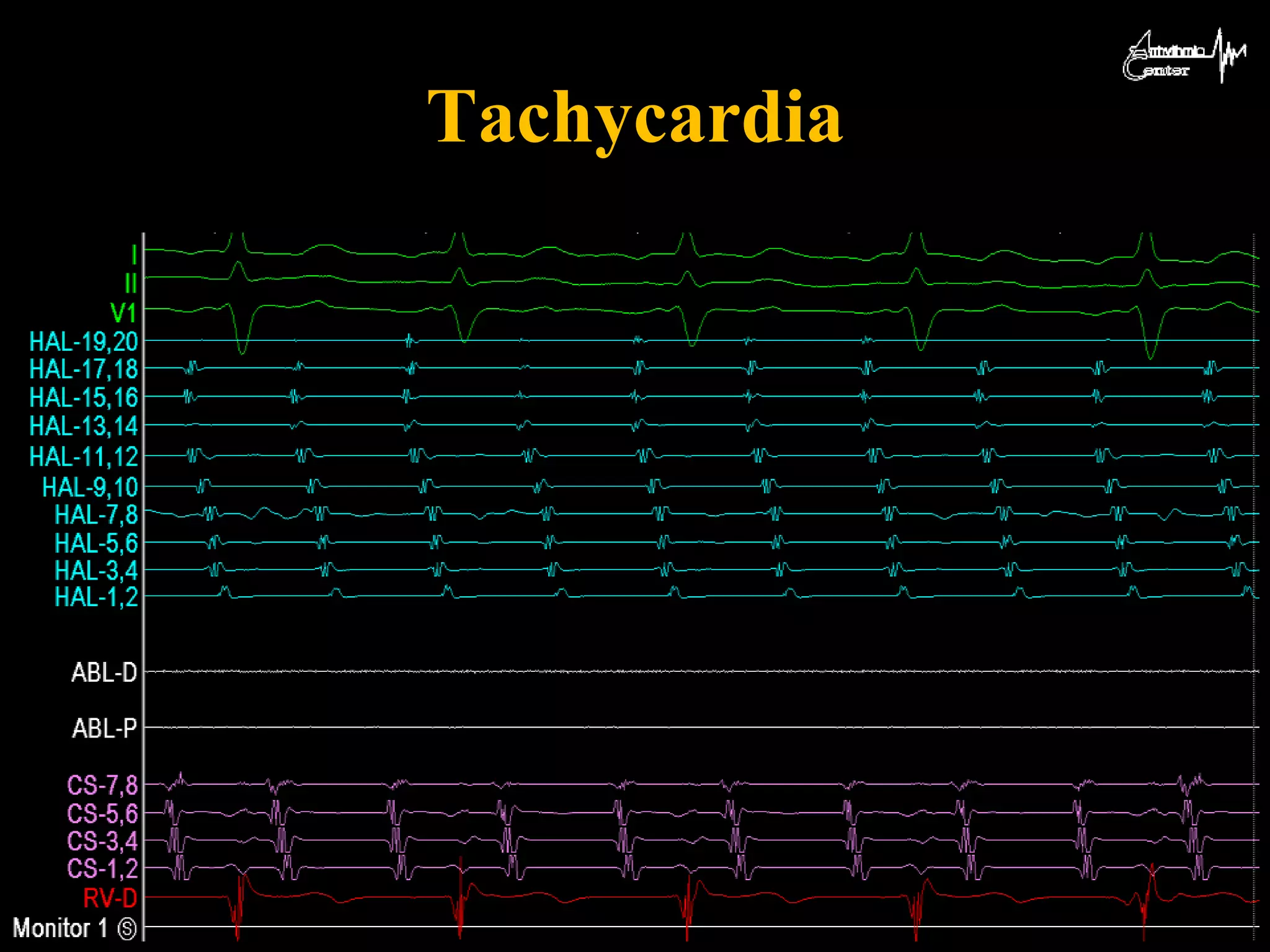 Ablation Of Atypical Flutter Pptx