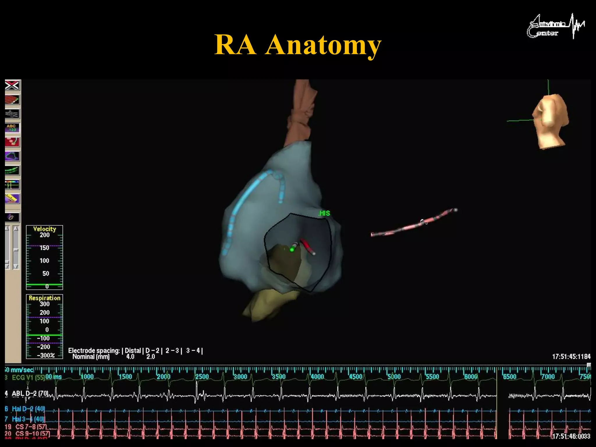 Ablation of atypical flutter | PPTX