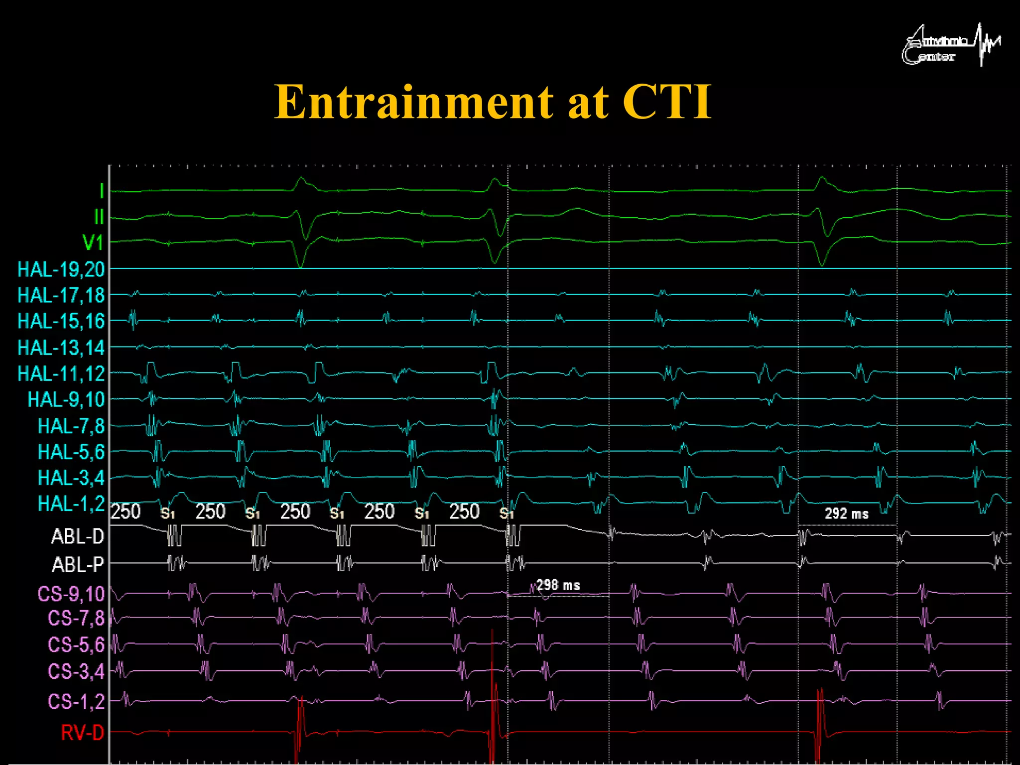 Ablation Of Atypical Flutter Pptx