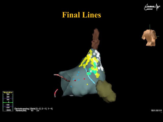 Ablation of atypical flutter | PPTX