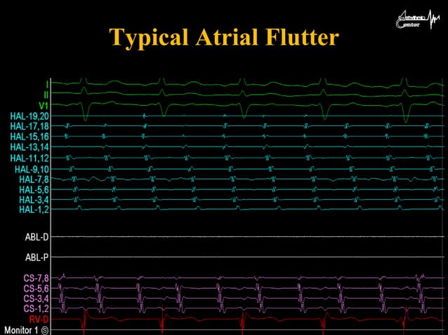 Ablation of atypical flutter | PPTX