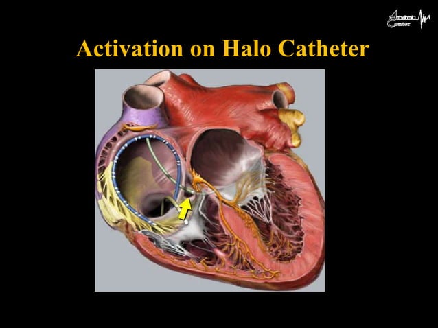 Ablation Of Atypical Flutter Pptx