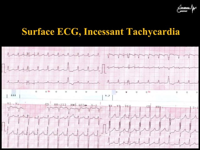 Ablation of atypical flutter | PPTX