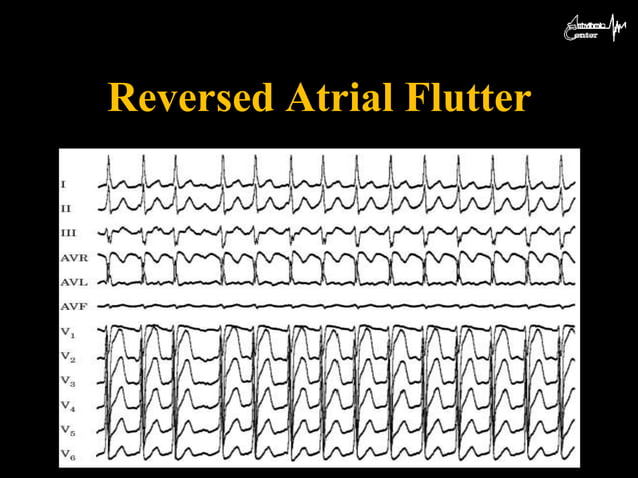 Ablation Of Atypical Flutter Ppt