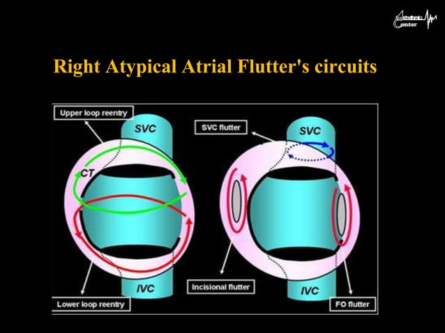 Ablation of atypical flutter | PPTX