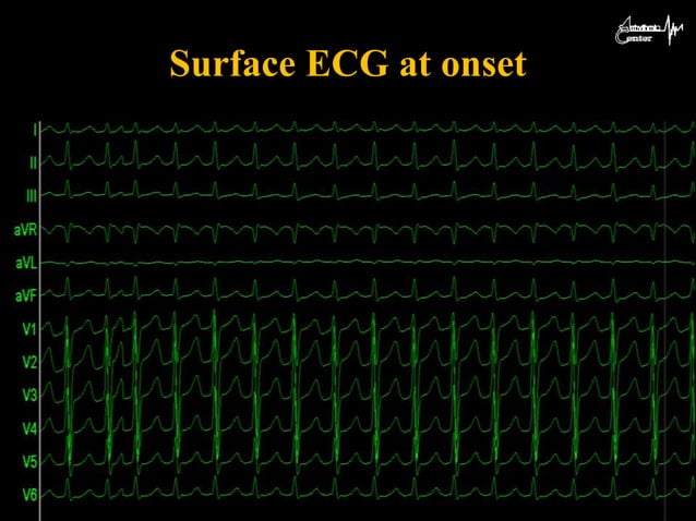Ablation of atypical flutter | PPTX