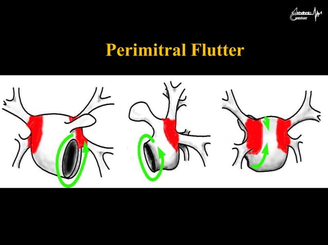 Ablation of atypical flutter | PPTX