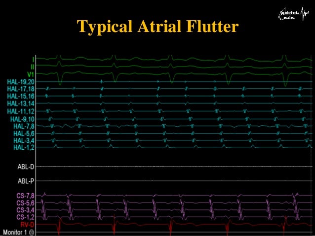 Ablation of atypical flutter