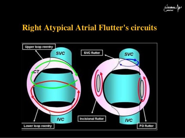 Ablation of atypical flutter