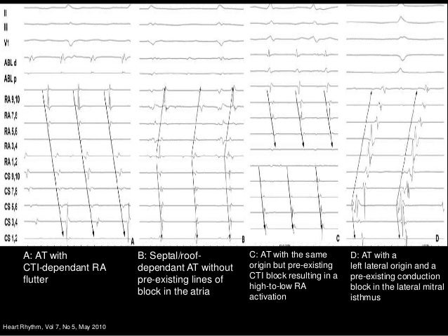 A Flutter Ablation Success Rate Pereli