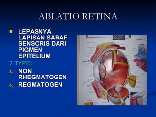 Ablatio retina | PPT