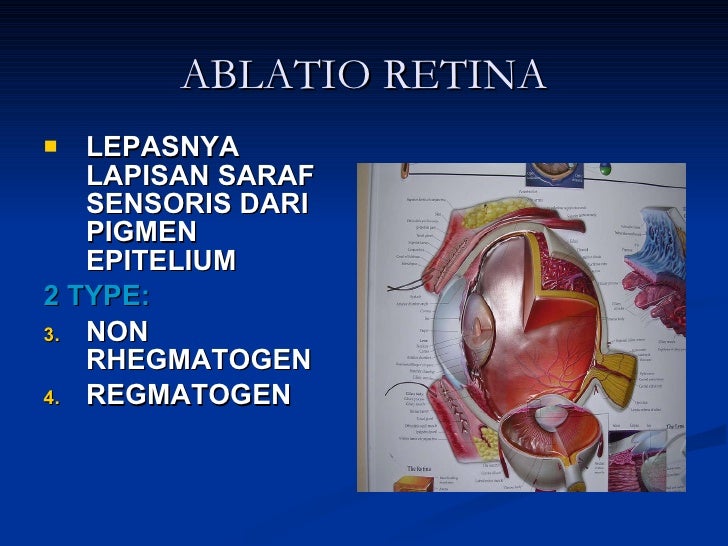 Ablatio retina