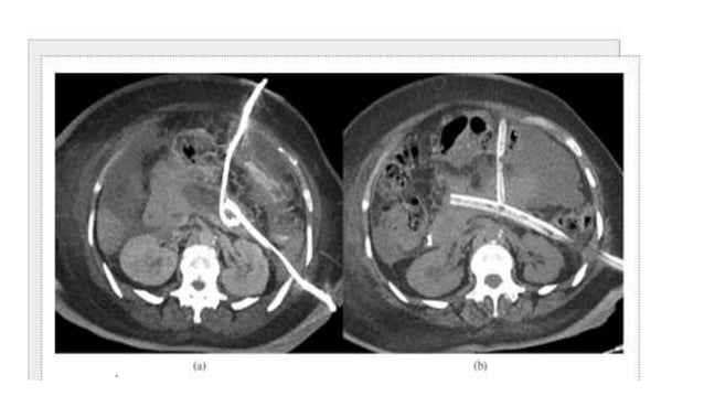 Abnormal abdominal ct ppt slide | PPTX