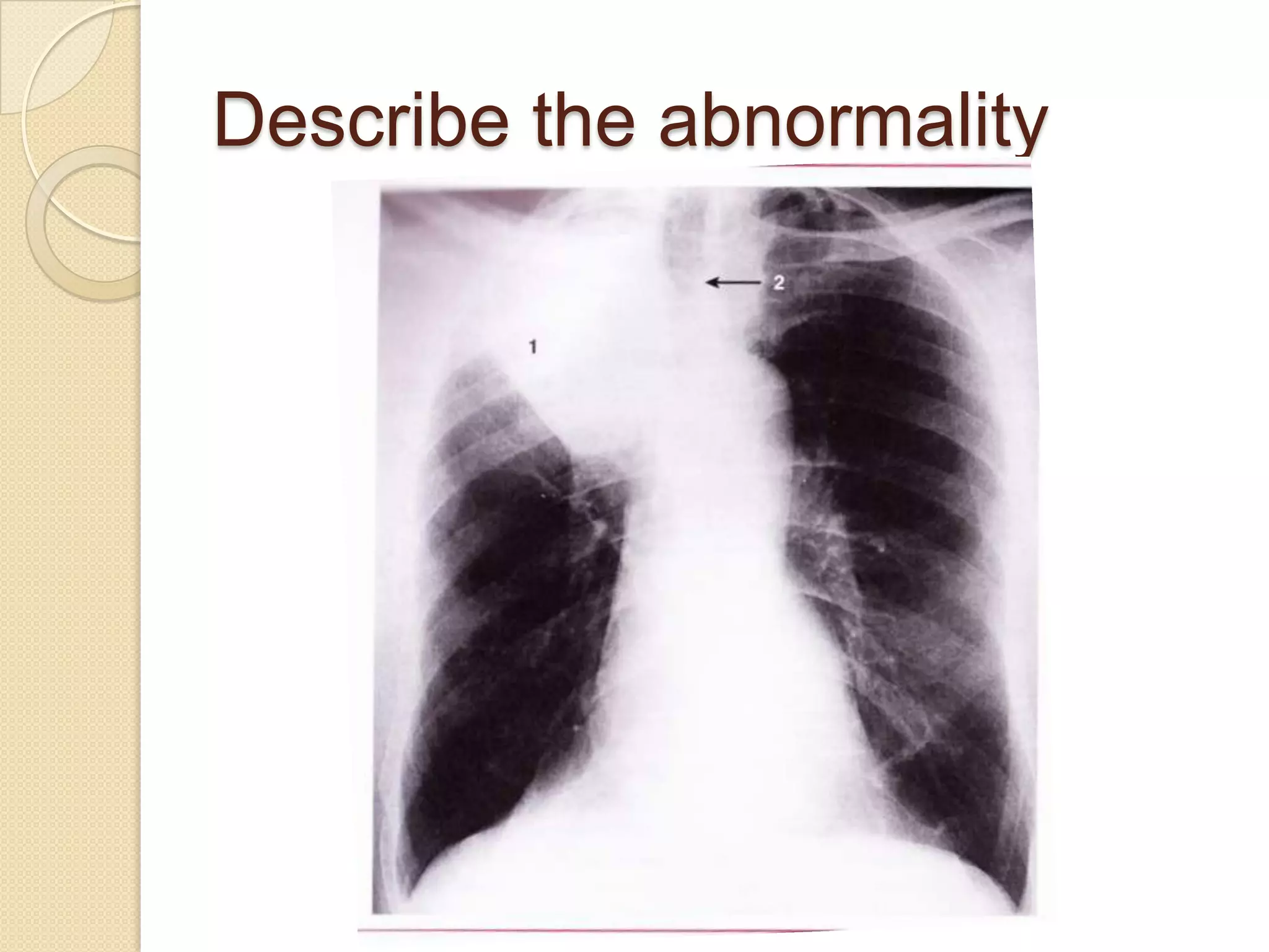 Abnormal chest radiograph part 1 | PPTX