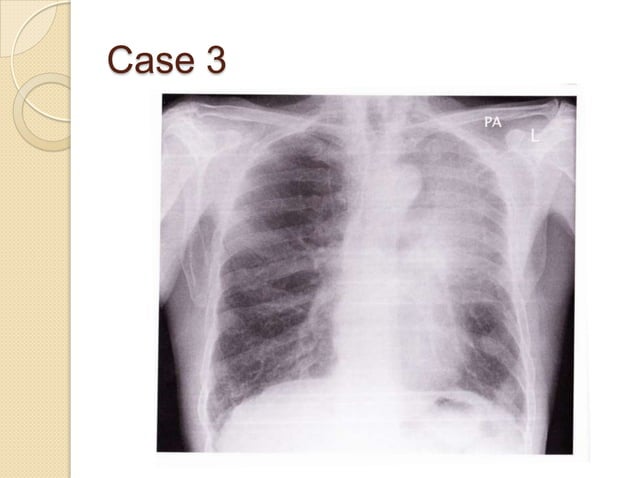 Abnormal chest radiograph part 1 | PPTX