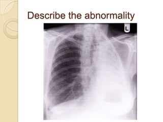 Abnormal chest radiograph part 1 | PPTX