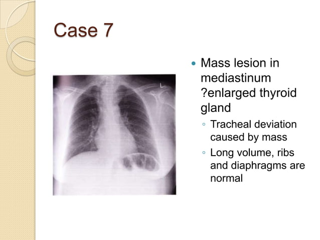 Abnormal chest radiograph part 1 | PPTX