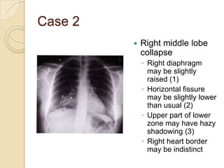Abnormal chest radiograph part 1 | PPTX