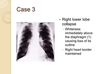 Abnormal chest radiograph part 1 | PPTX
