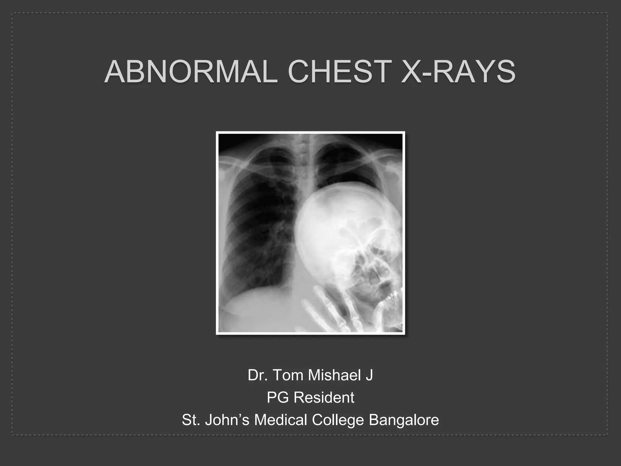 Abnormal Chest X rays | PPTX | Lung and Respiratory Health | Diseases and Conditions