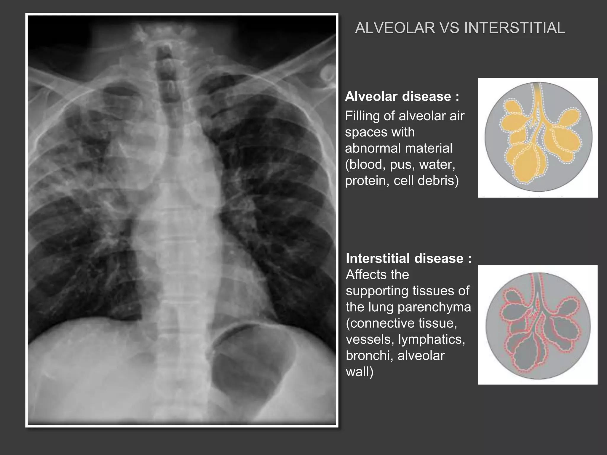 Abnormal Chest X rays | PPTX | Lung and Respiratory Health | Diseases ...