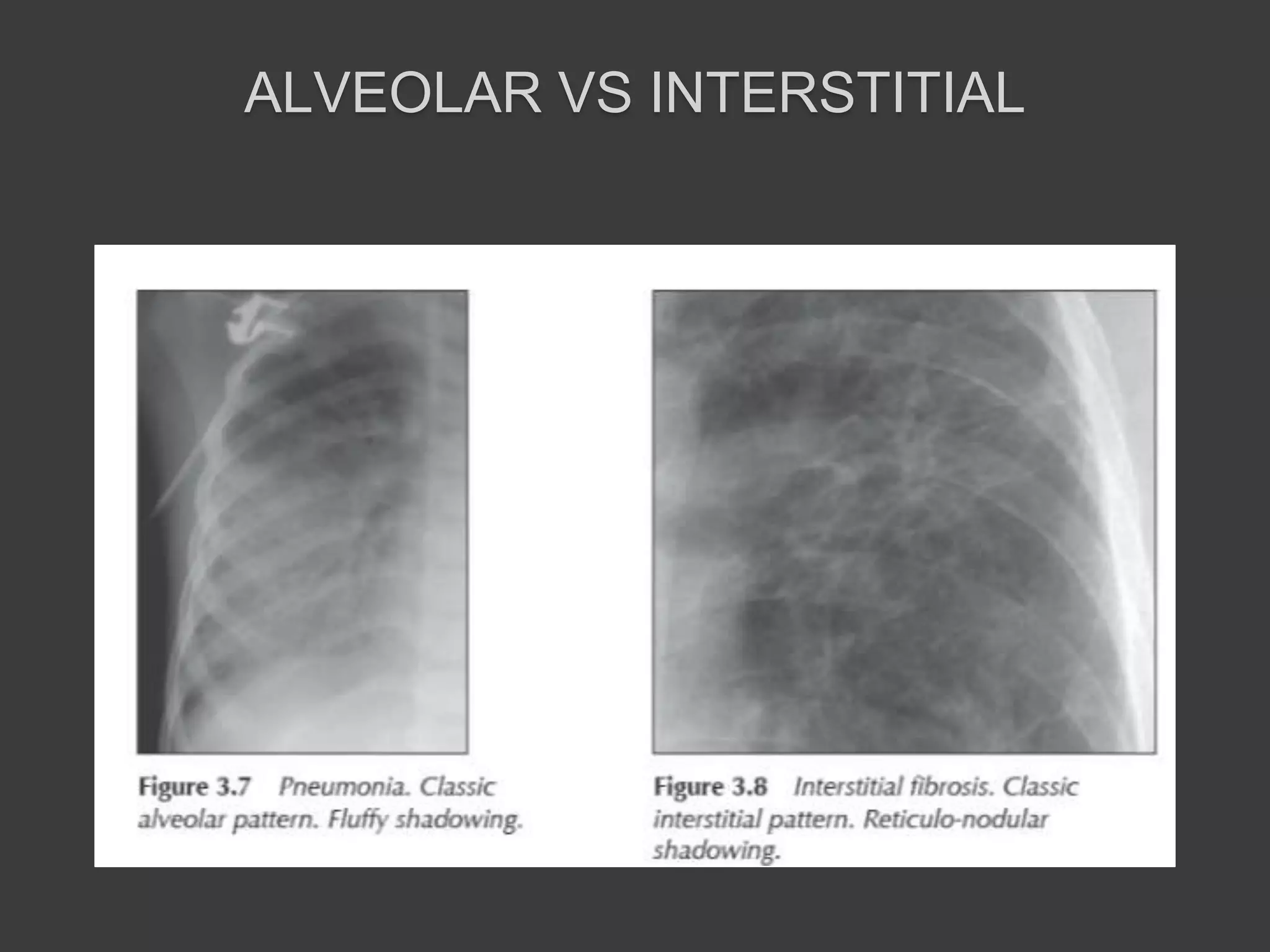 Abnormal Chest X rays | PPTX | Lung and Respiratory Health | Diseases ...