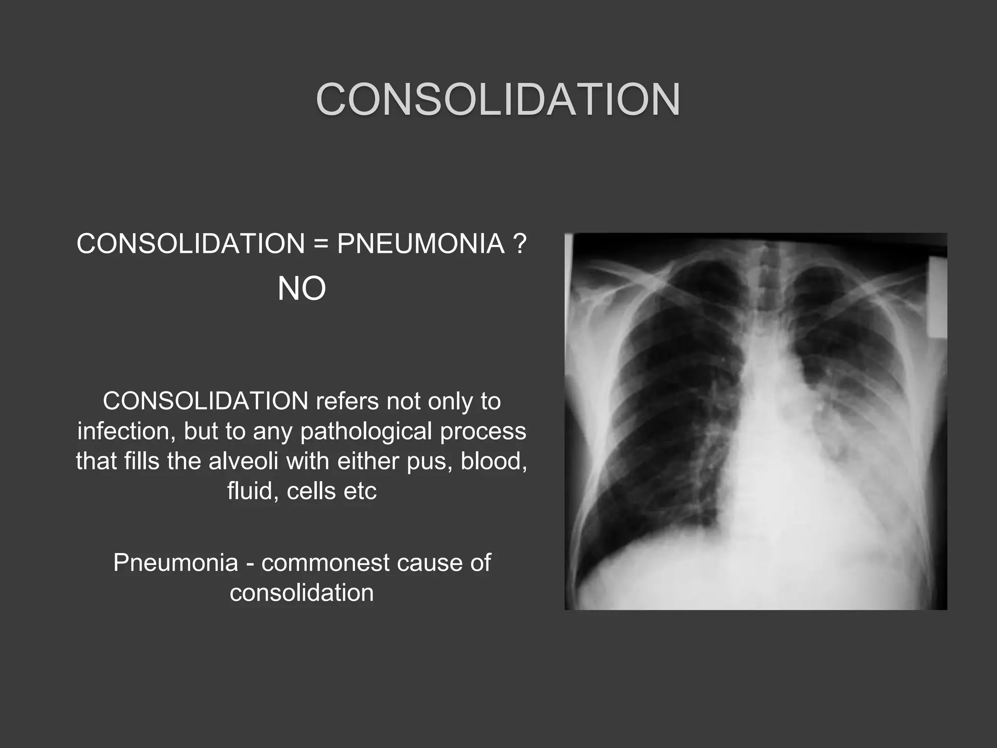 Abnormal Chest X rays | PPTX