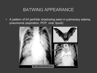 Abnormal Chest X Rays Pptx
