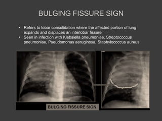 Abnormal Chest X rays | PPTX