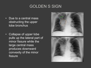 Abnormal Chest X rays | PPTX