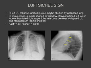 Abnormal Chest X rays | PPTX
