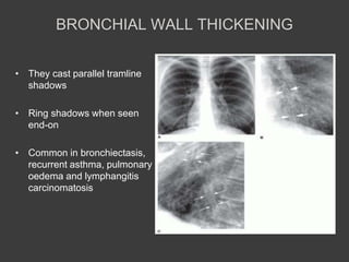 Abnormal Chest X rays | PPTX