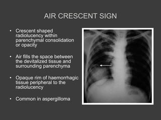 Abnormal Chest X rays | PPTX
