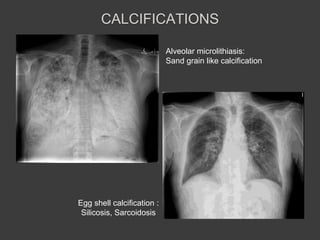 Abnormal Chest X rays | PPTX