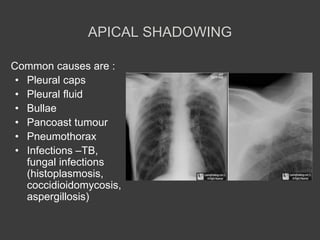 Abnormal Chest X rays | PPTX