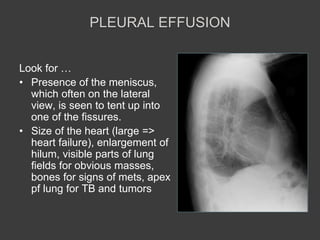 Abnormal Chest X rays | PPTX