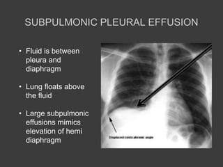 Abnormal Chest X rays | PPTX