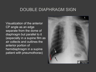 Abnormal Chest X rays | PPT