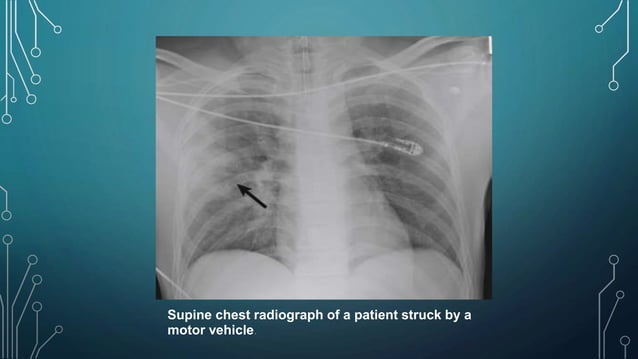 ABNORMAL CHEST XRAY in Icu care technology.pptx