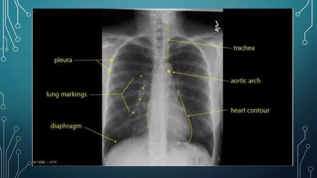 ABNORMAL CHEST XRAY in Icu care technology.pptx