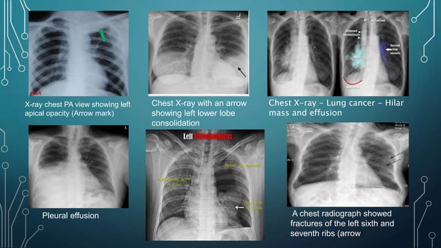 ABNORMAL CHEST XRAY in Icu care technology.pptx