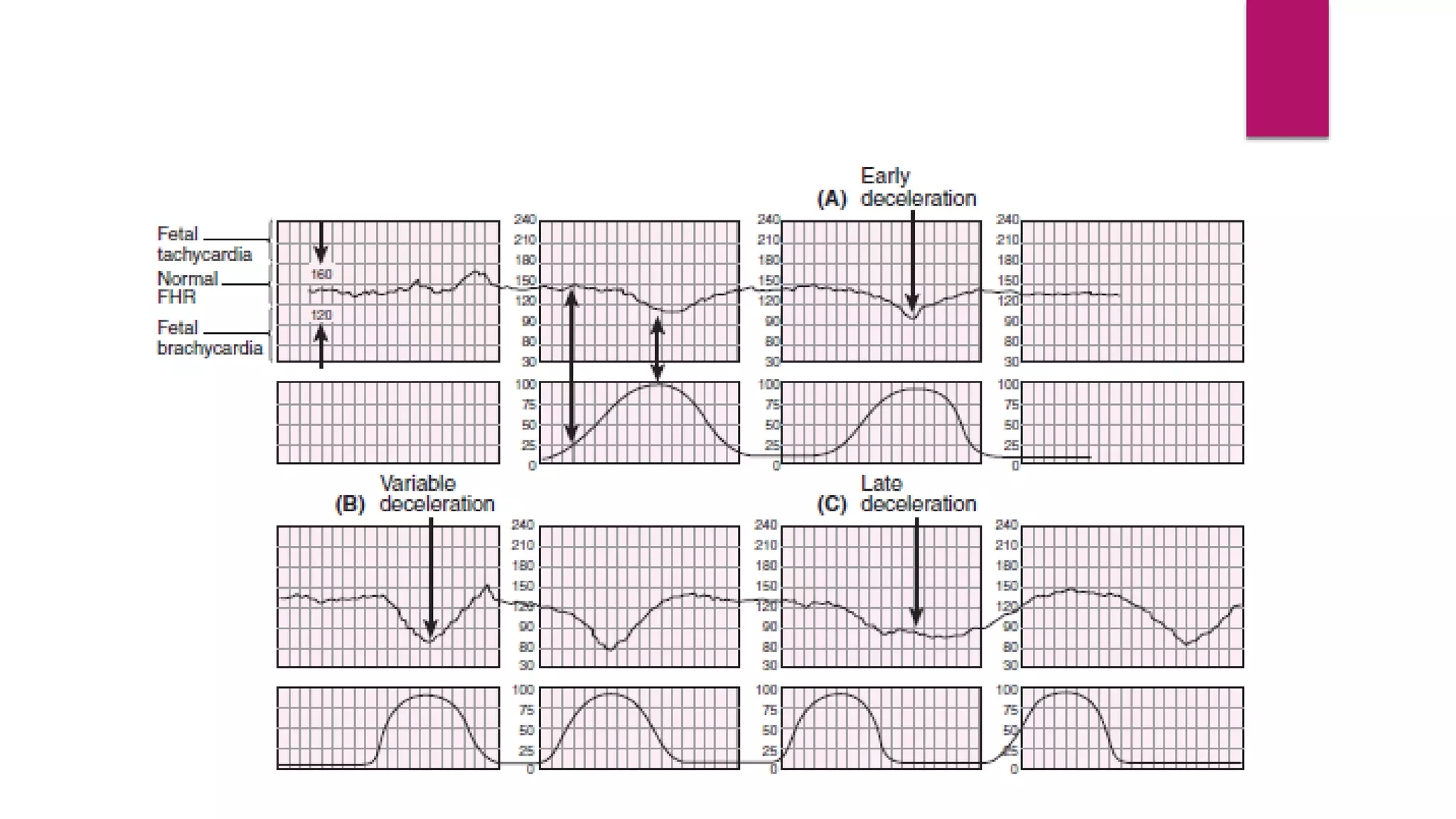 Abnormal CTG | PPTX