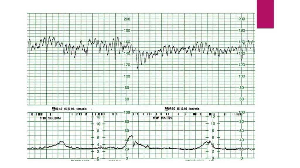 Abnormal CTG