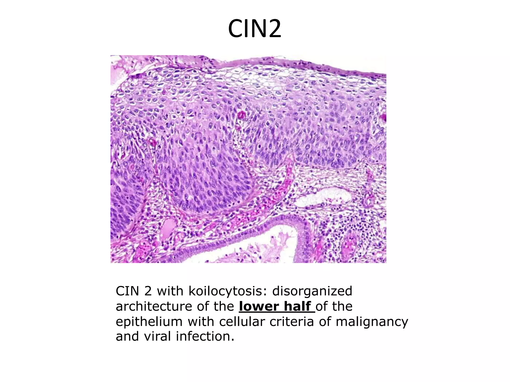 Abnormal cytology & histology of cervix _ Histopathology | PPT