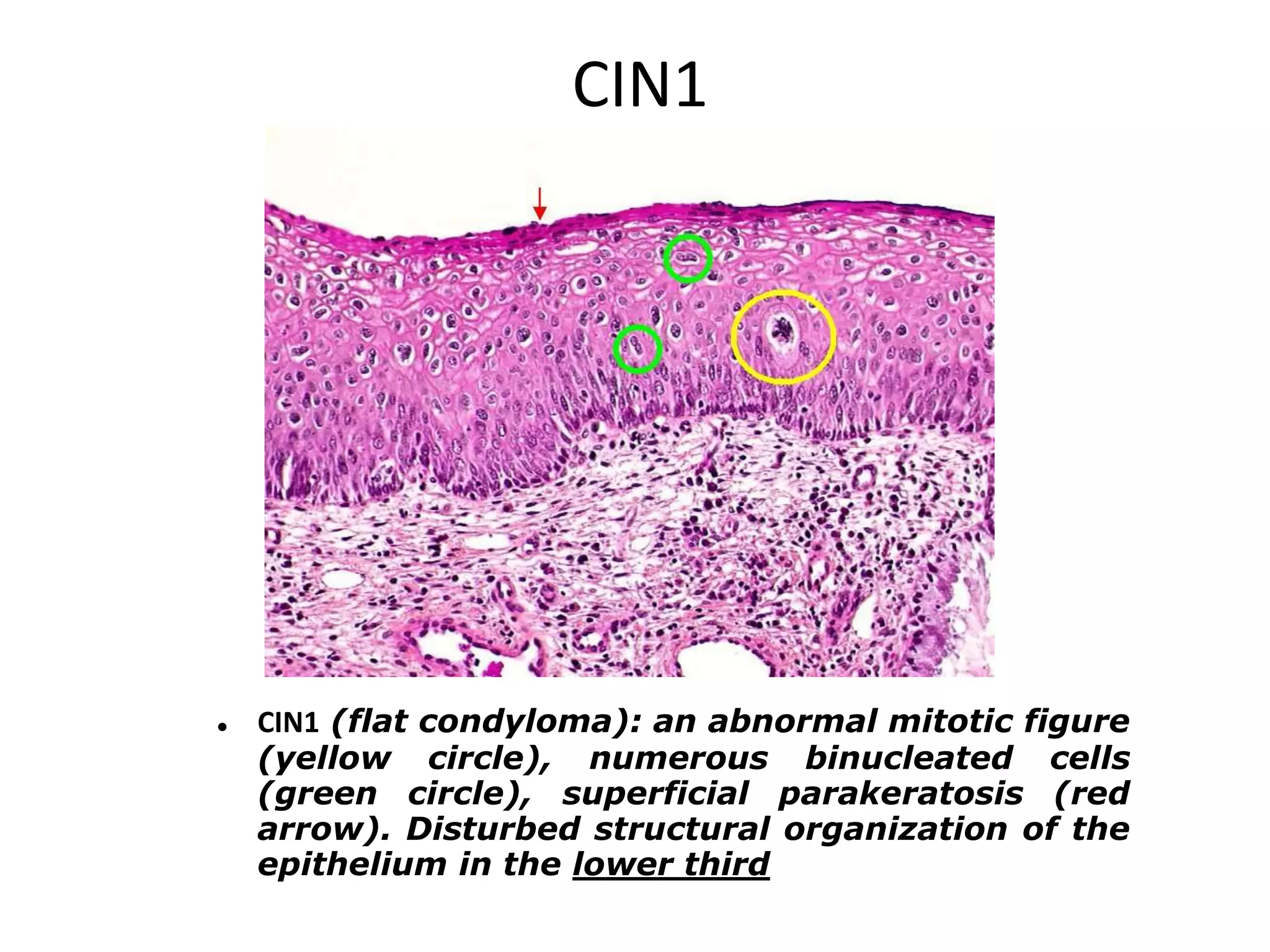 Abnormal cytology & histology of cervix _ Histopathology | PPT
