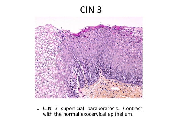 Abnormal cytology & histology of cervix _ Histopathology | PPT ...