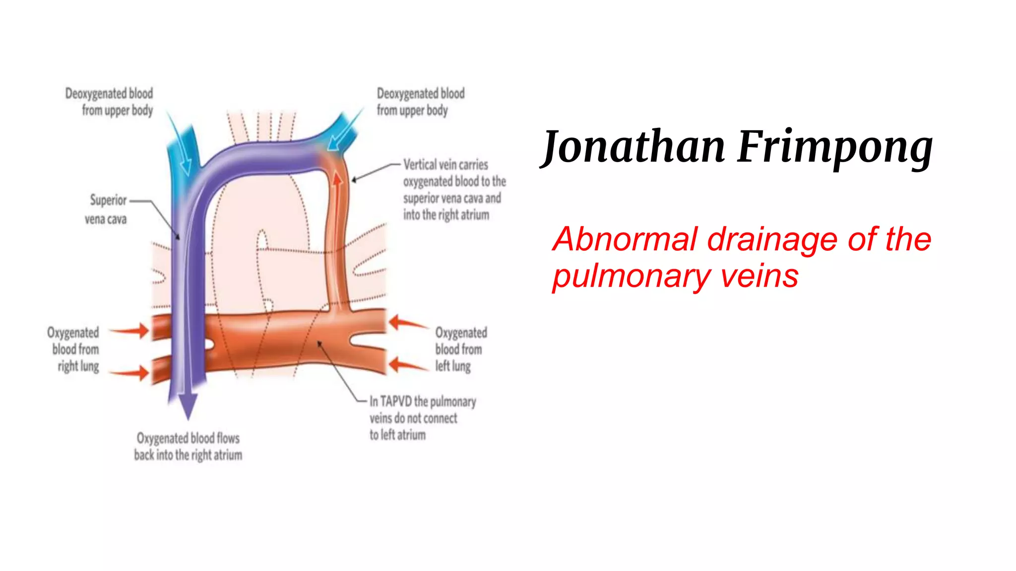 Abnormal drainage of the pulmonary veins jf.pptx