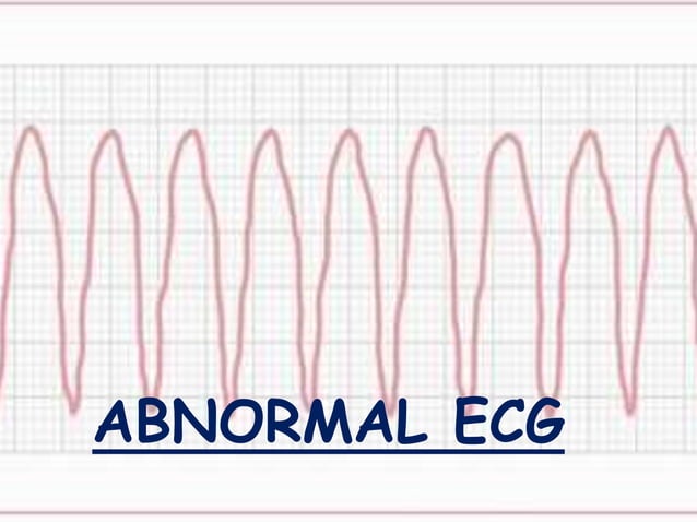Abnormal Electrocardiography | PPTX