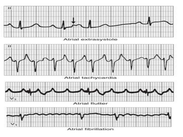 Abnormal Electrocardiography | PPTX
