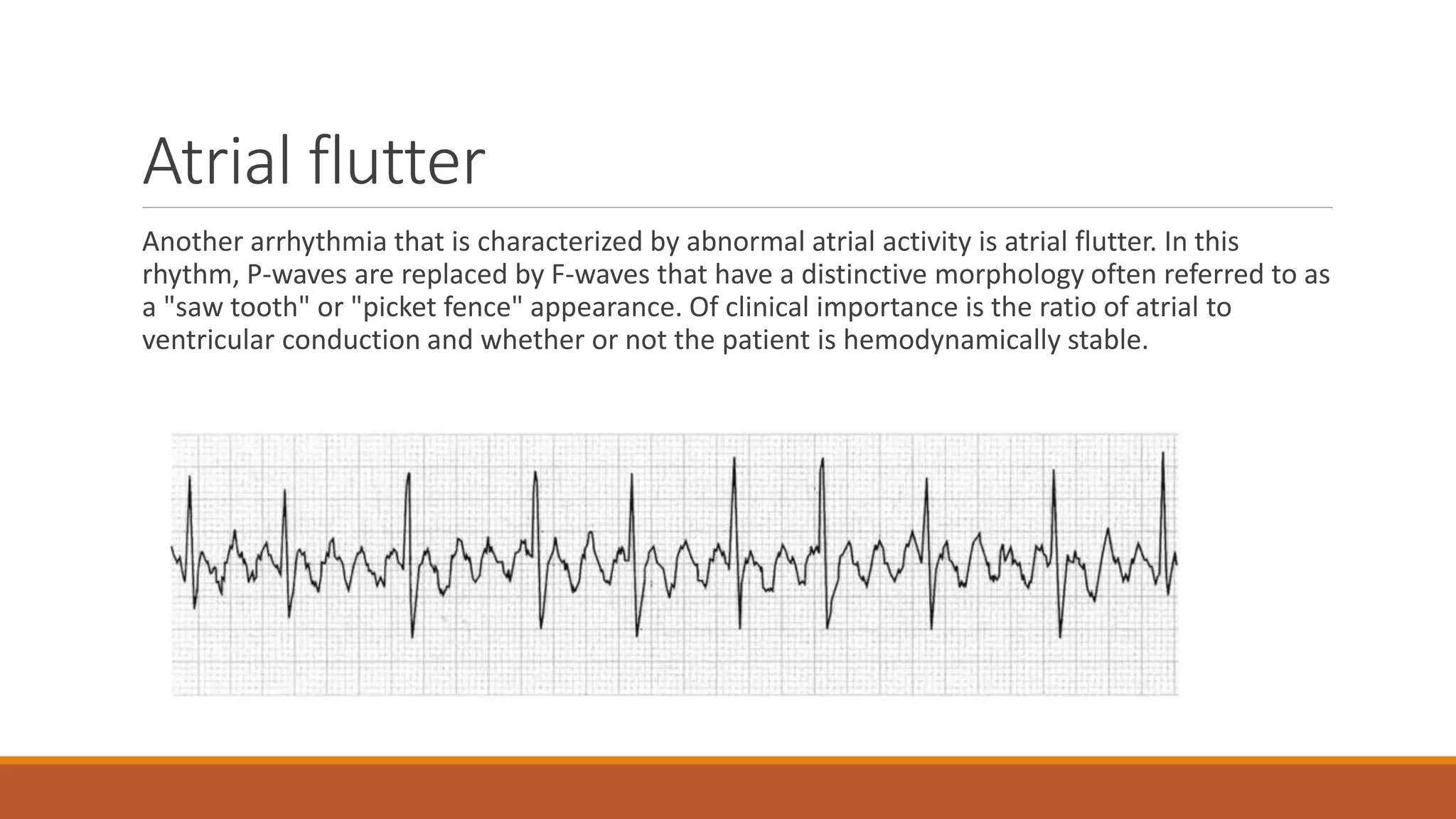 Abnormal ECG- Arhythmia.pptx